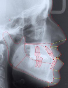 Soft tissue profile prediction – facad.com